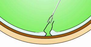 硝子体手術 - 亀谷アイクリニック